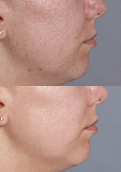 Acne Scar Treatment Powell, Ohio | RF Microneedling & CO₂ Laser